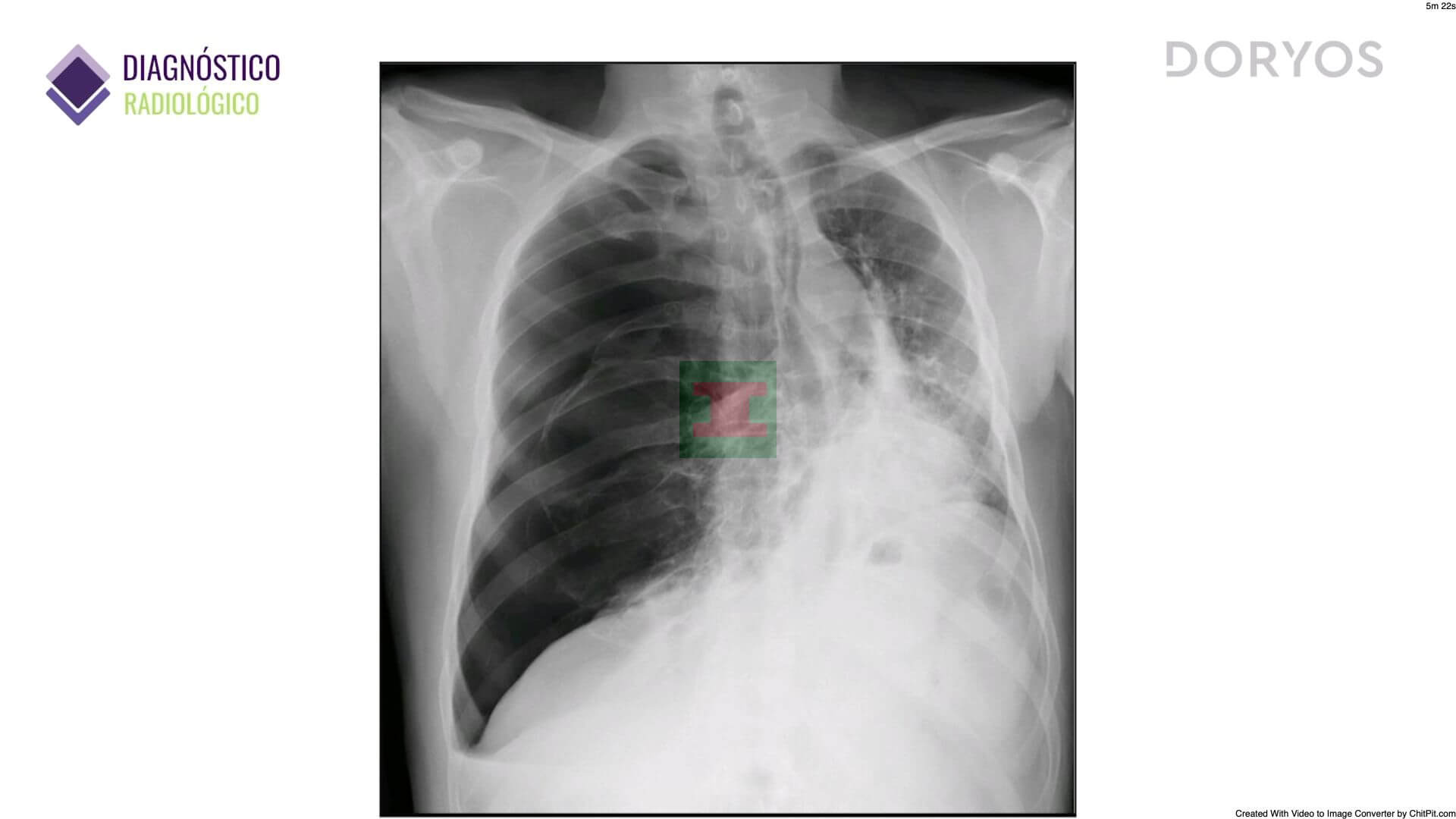 Manejo del neumotórax : Doryos
