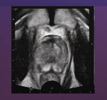 Técnica de biopsia transperineal guiada por RMM : Doryos