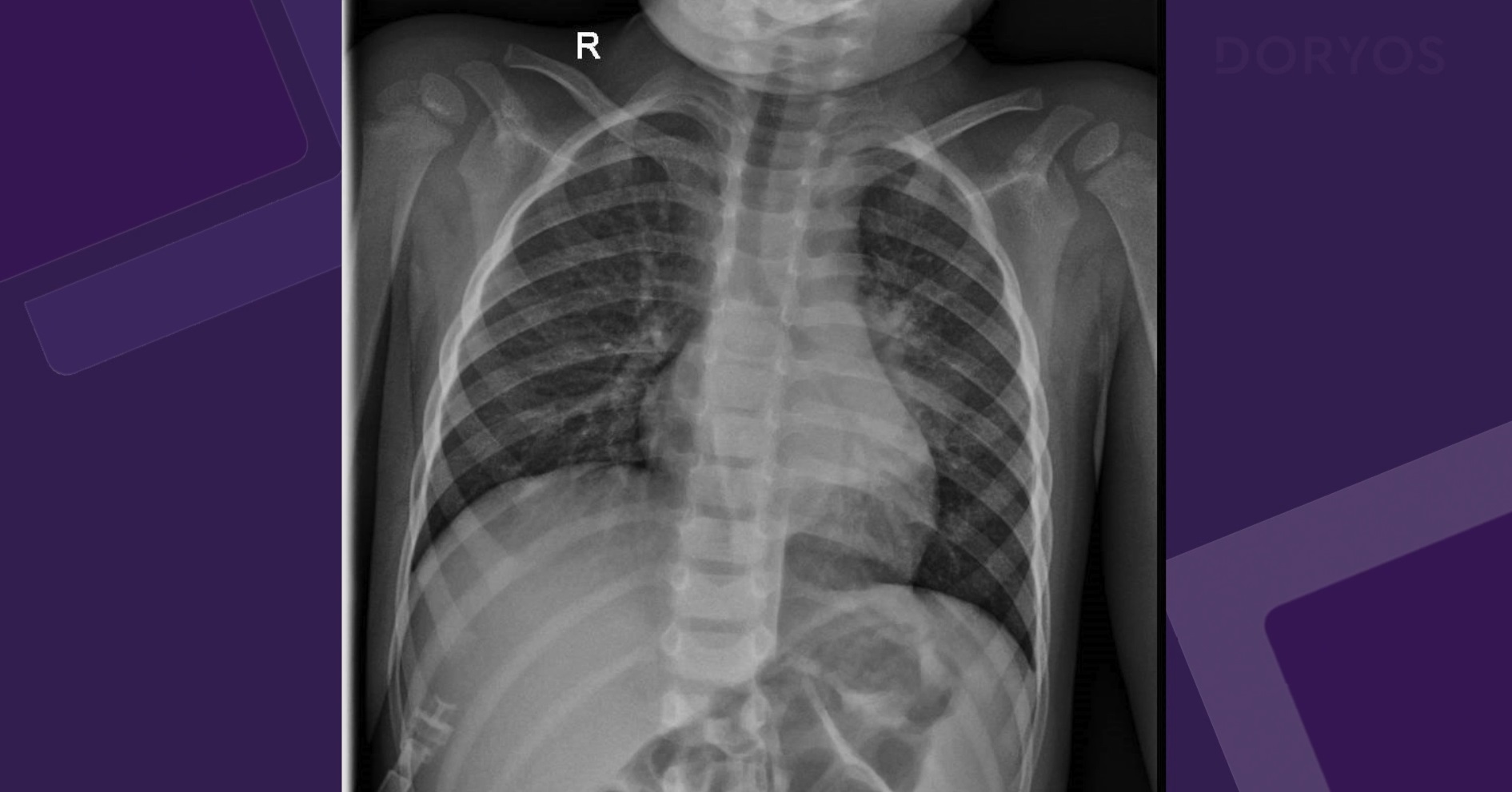 Tuberculosis en pediatría : Doryos