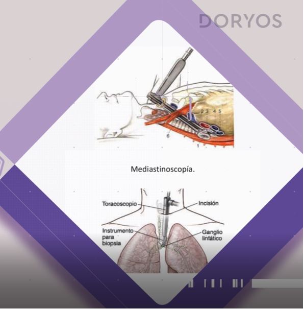 Vías de abordaje del tórax. Incisiones torácicas : Doryos