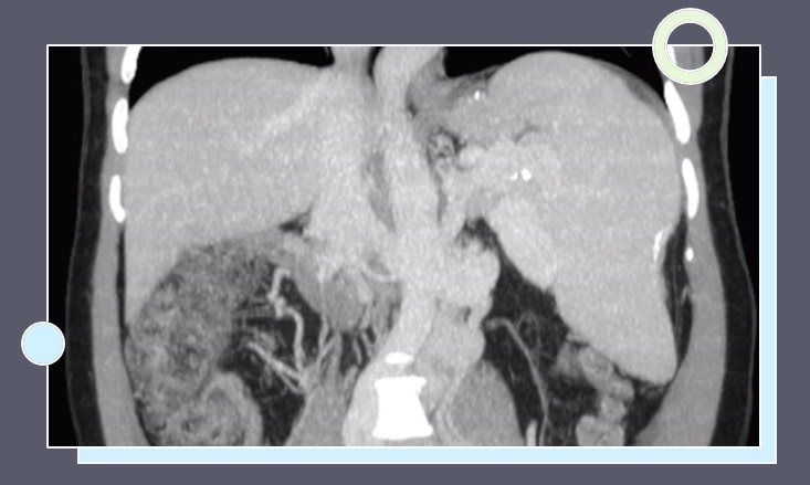 Filtro de vena cava, colocación y retirada. Parte 1 : Doryos