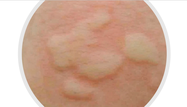 Habones y/o Angioedema. Parte 2 : Doryos