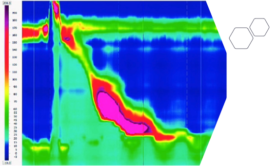 ¿Cómo interpretar una manometría esofágica desde el punto de vista de ...