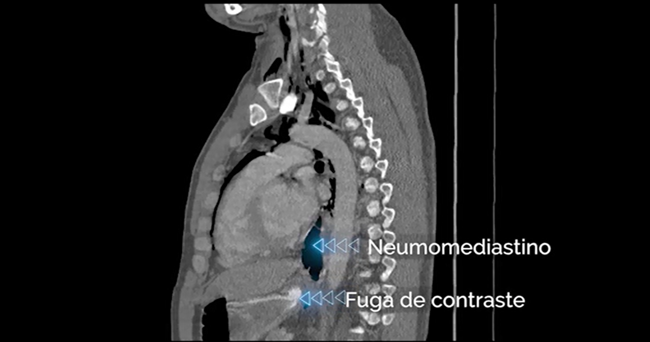 Perforación esofágica. La prótesis esofágica - Doryos : Doryos