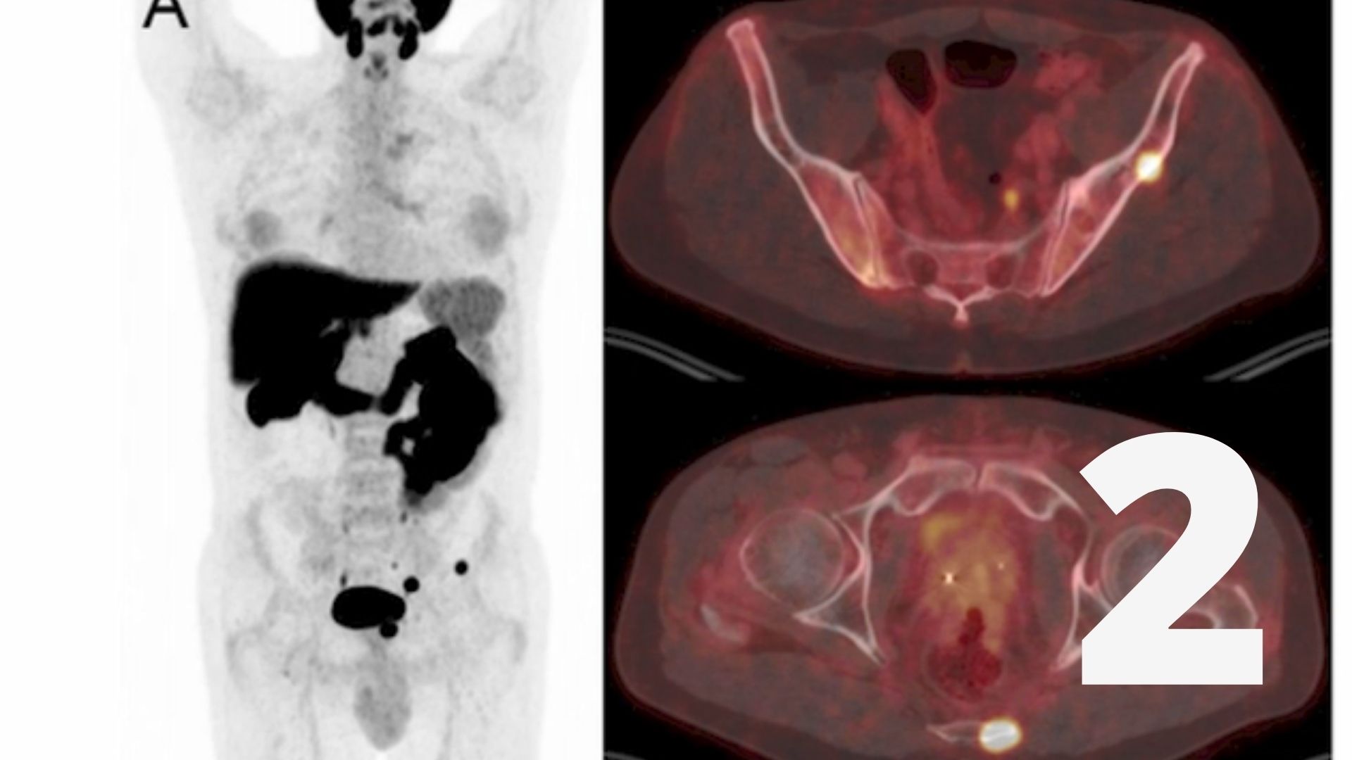 Recidiva bioquímica repercusión clínica - Dr. López Campos Parte 2 : Doryos