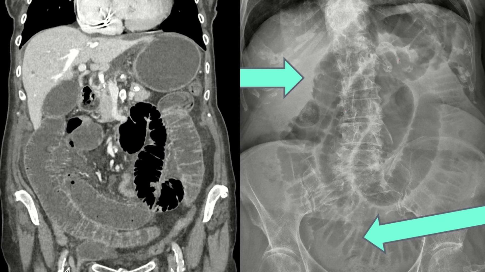 Obstrucción intestinal secundaria a hernia crural - Doryos : Doryos