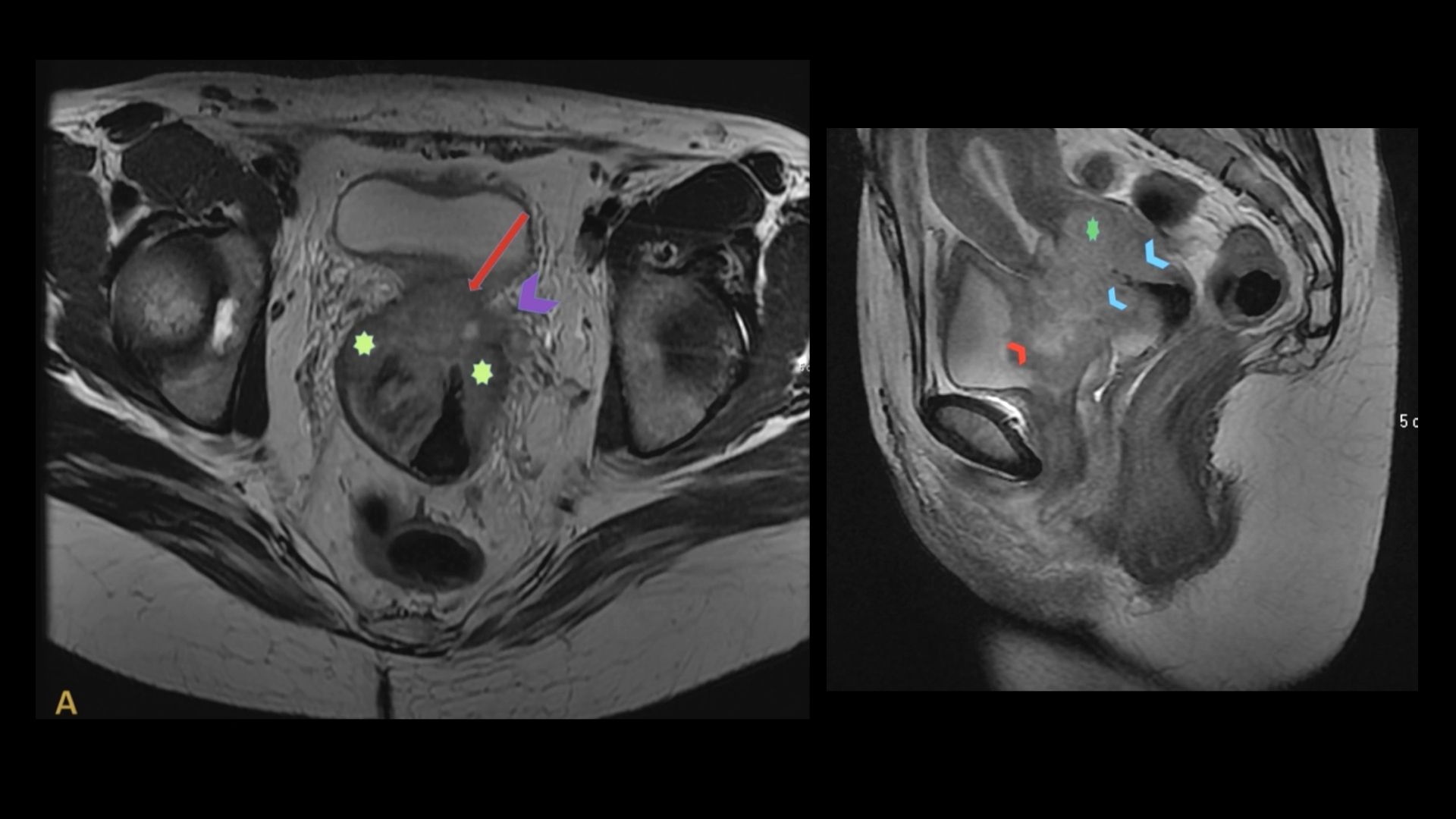 Estudio RM de la anatomía y patología de los ligamentos pélvicos ...