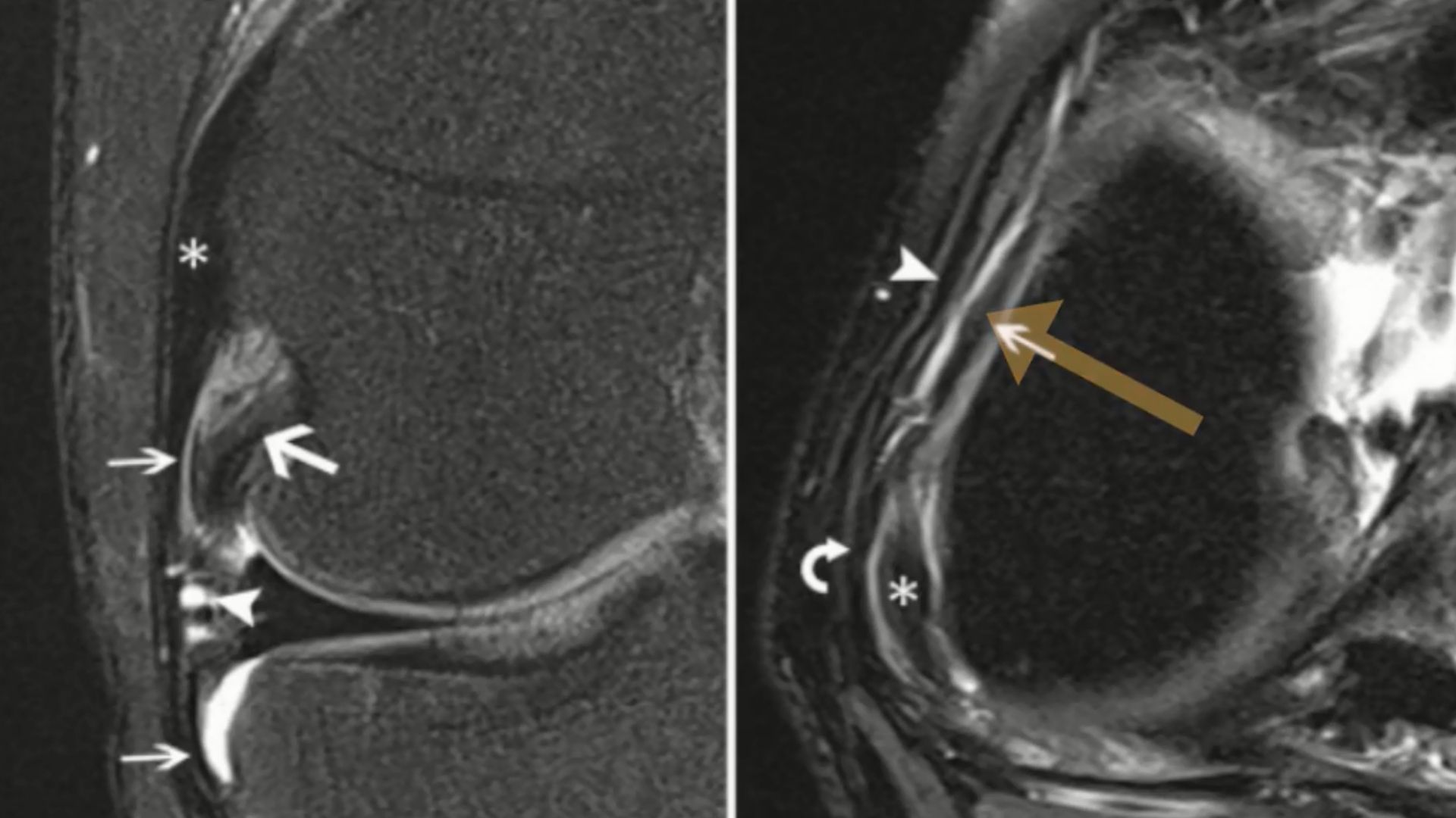 Ligamento anterolateral de la rodilla, fractura de Segond - Doryos : Doryos