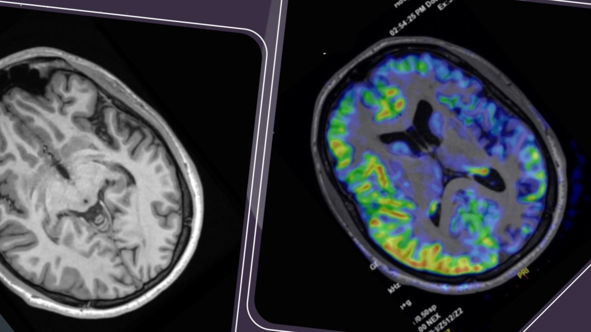 Arterial spin labeling en el síndrome de Rasmussen - Doryos : Doryos