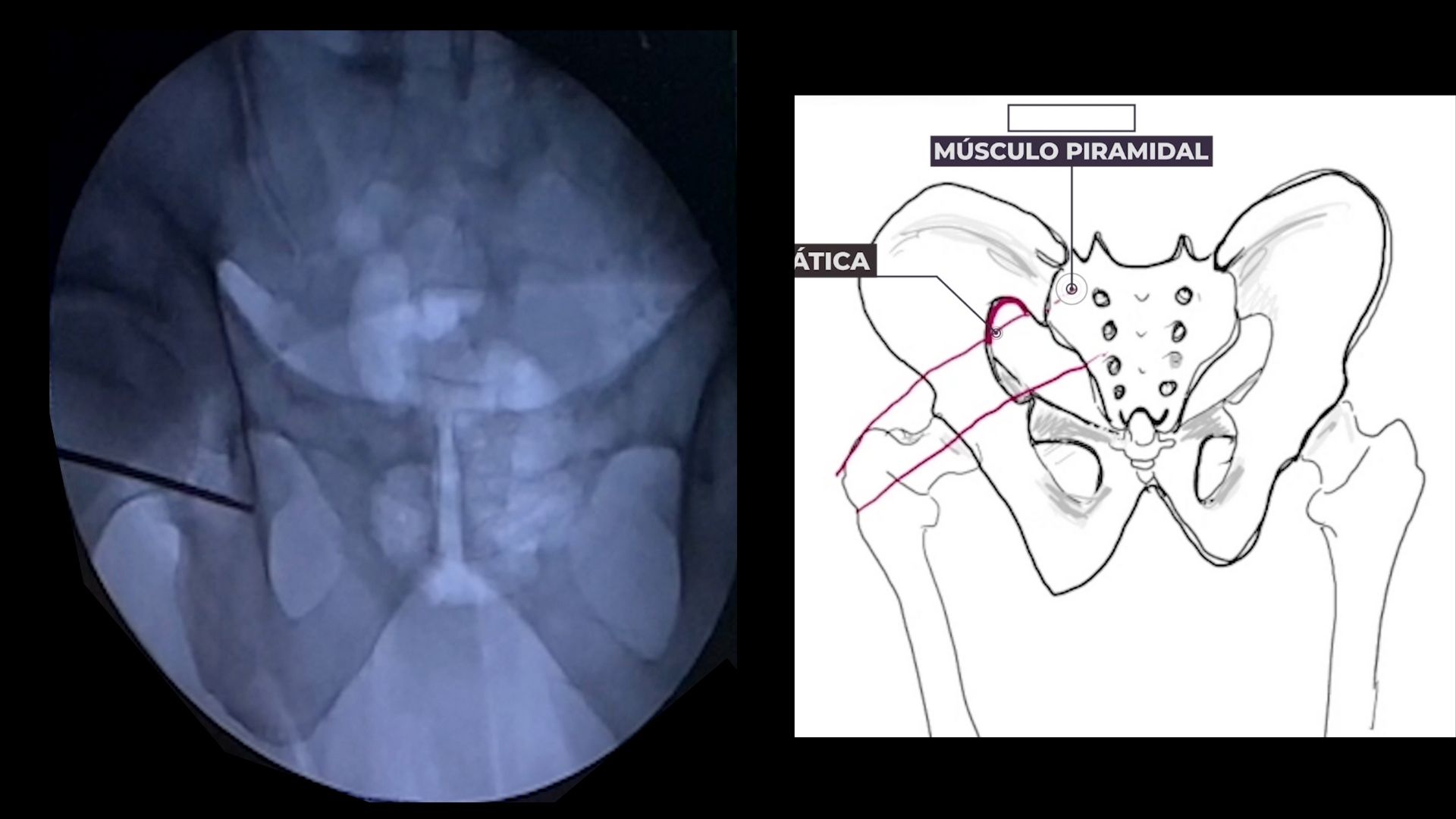 Abordaje del nervio pudendo. Unidad de dolor - Doryos : Doryos