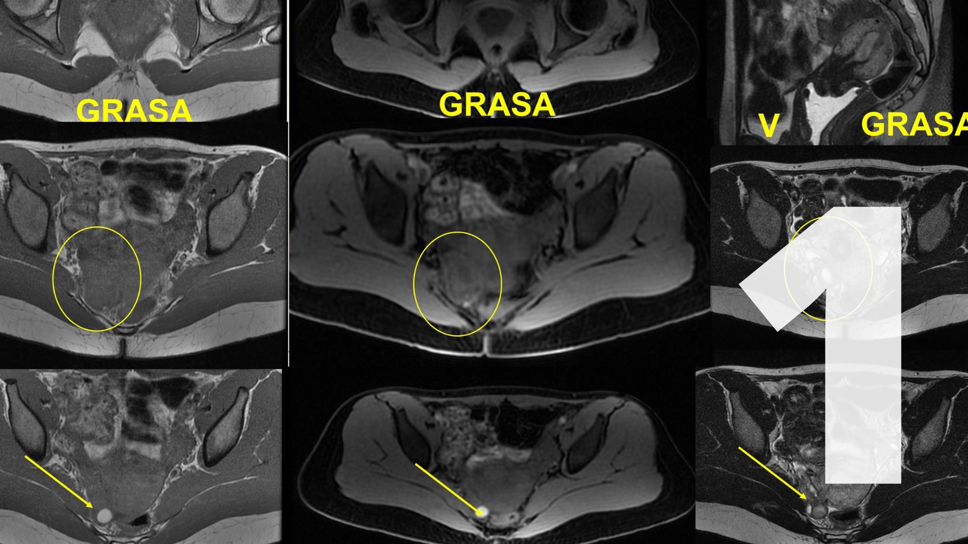 Diagnóstico por imagen de la endometriosis. Parte 1 : Doryos