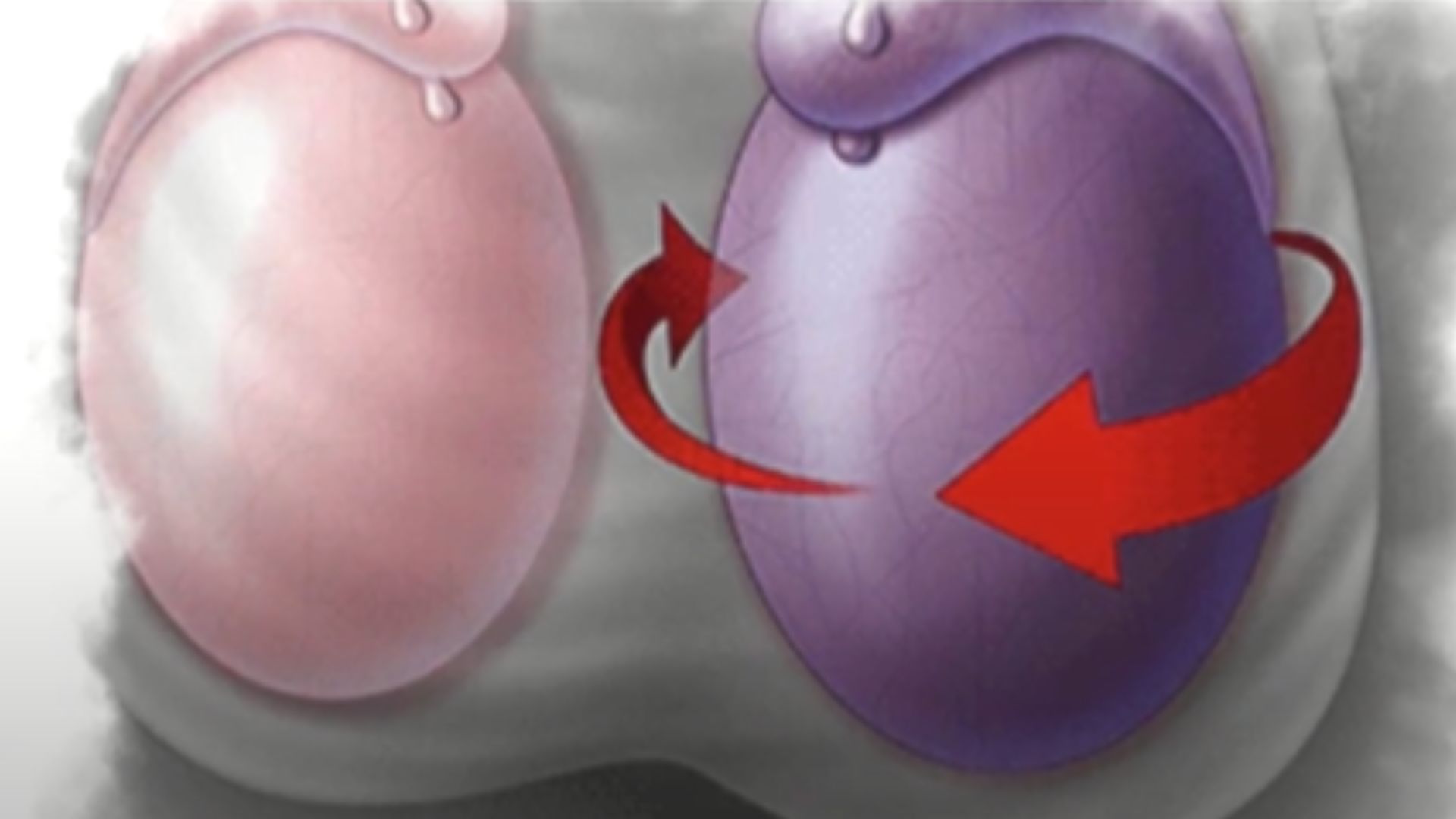 Diagnóstico Y Manejo Del Escroto Agudo En Urgencias Torsión Testicular