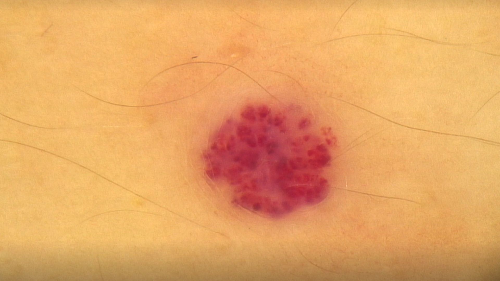 Angioma senil o punto rubí . Dermatología - Doryos : Doryos