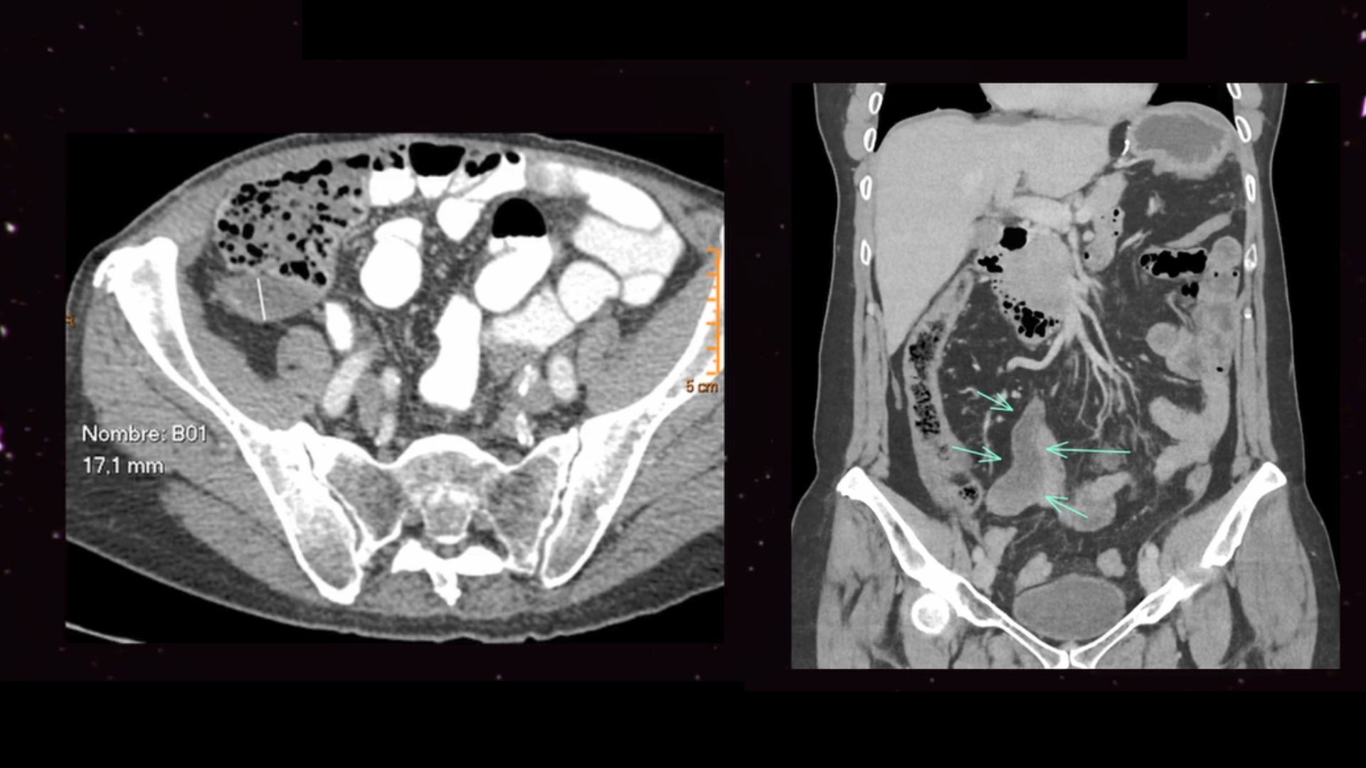 Mucocele apendicular: caso clínico - Doryos : Doryos