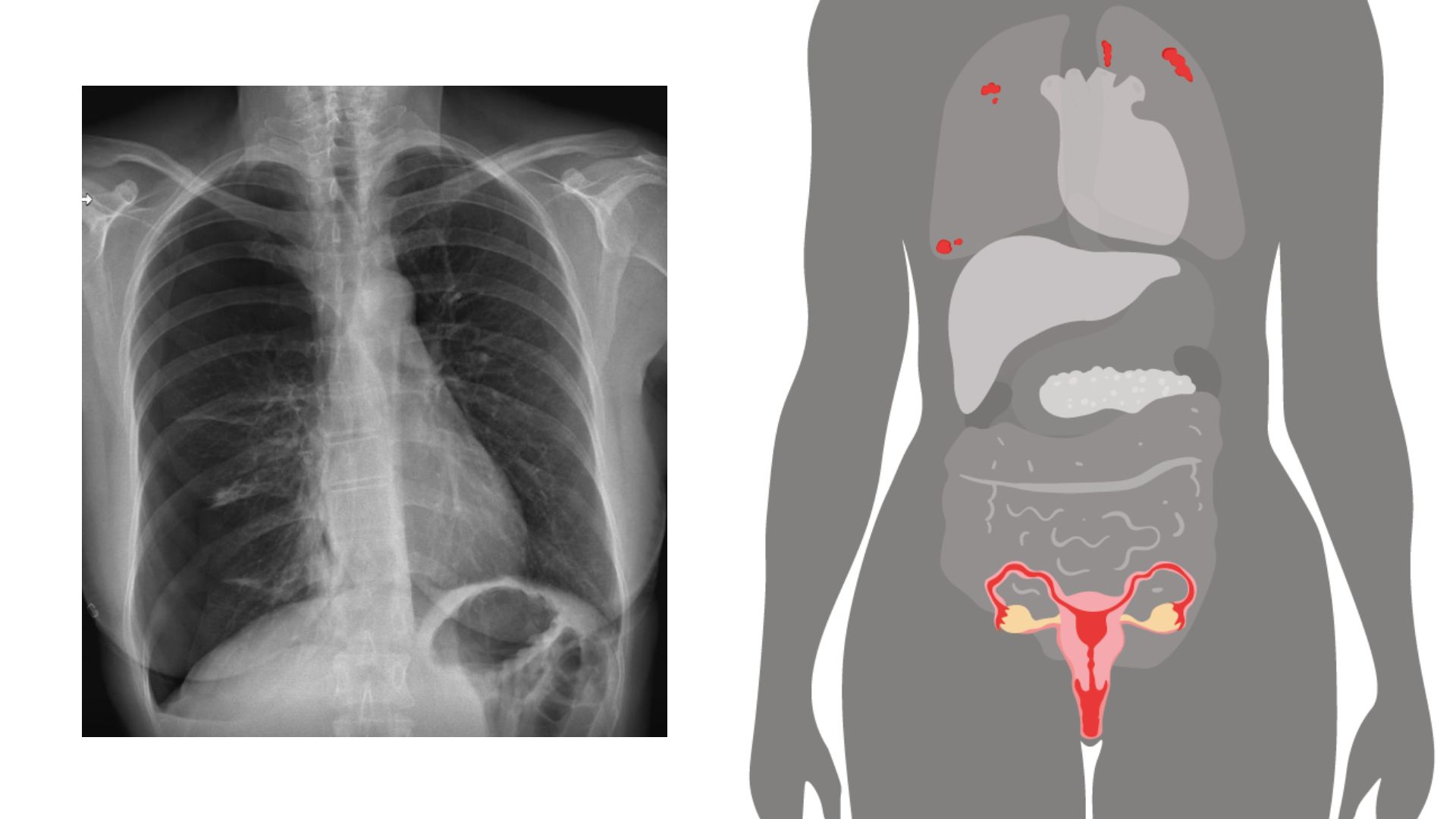 Neumotórax catamenial: manejo quirúrgico toracoscópico : Doryos