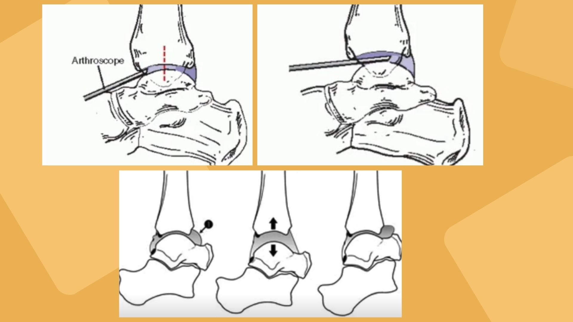 Artroscopia Anterior De Tobillo Bases E Introducción Doryos
