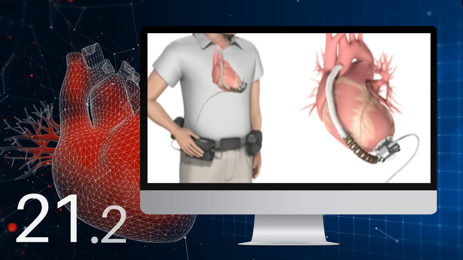 21.2. Falla cardiaca avanzada, manejo farmacológico : Doryos