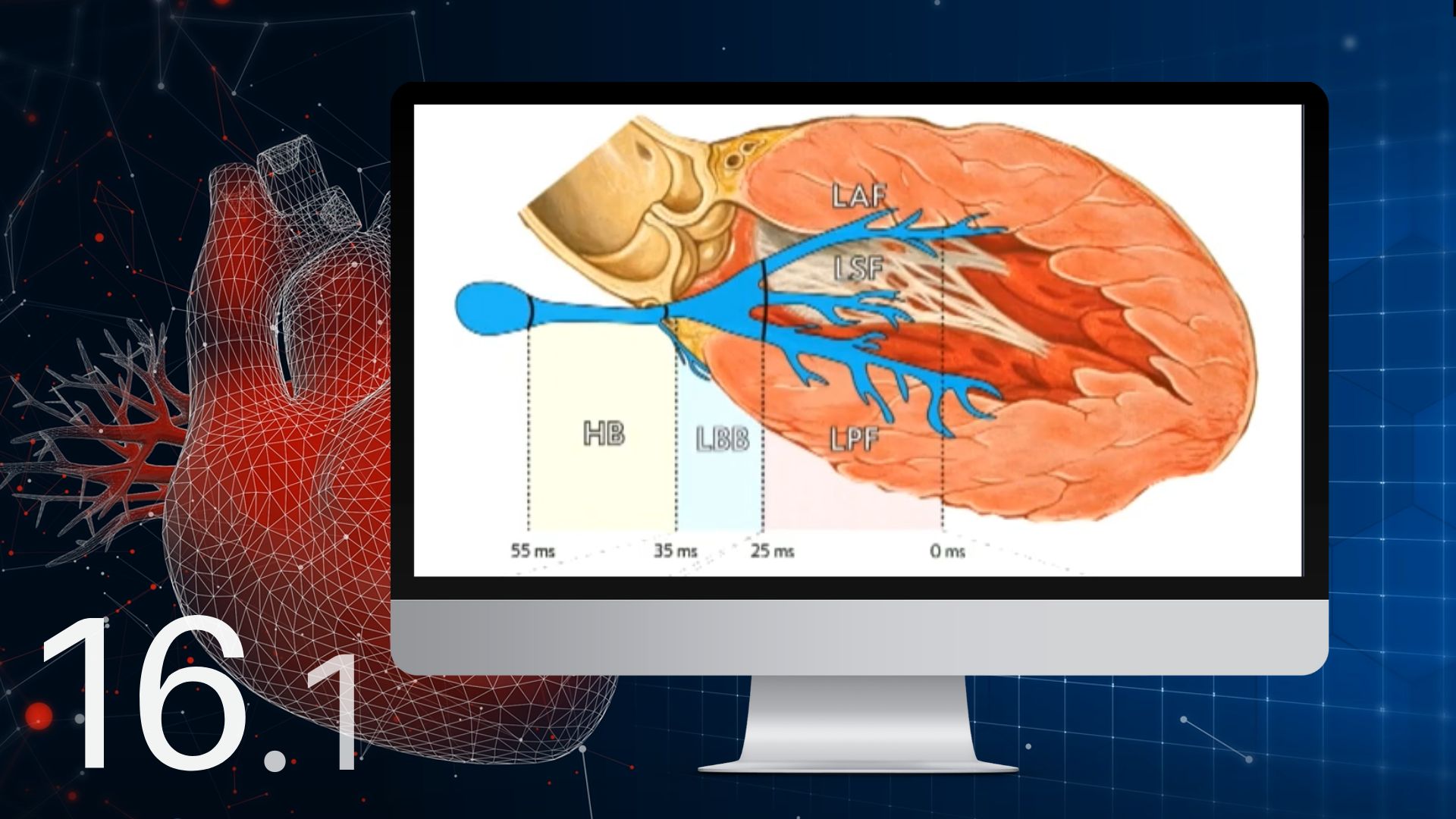 16.1. Estimulación de rama izquierda : Doryos
