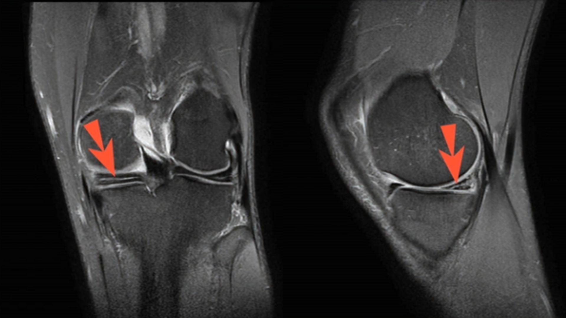 Reparación meniscal tipo "sándwich" para roturas horizontales tipo ...