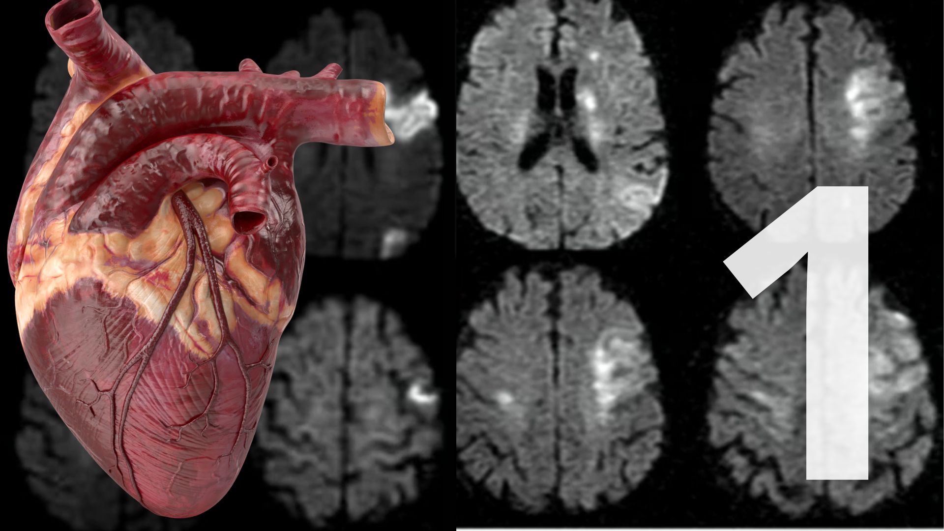 Novedades en ictus cardioembólico, parte 1 : Doryos