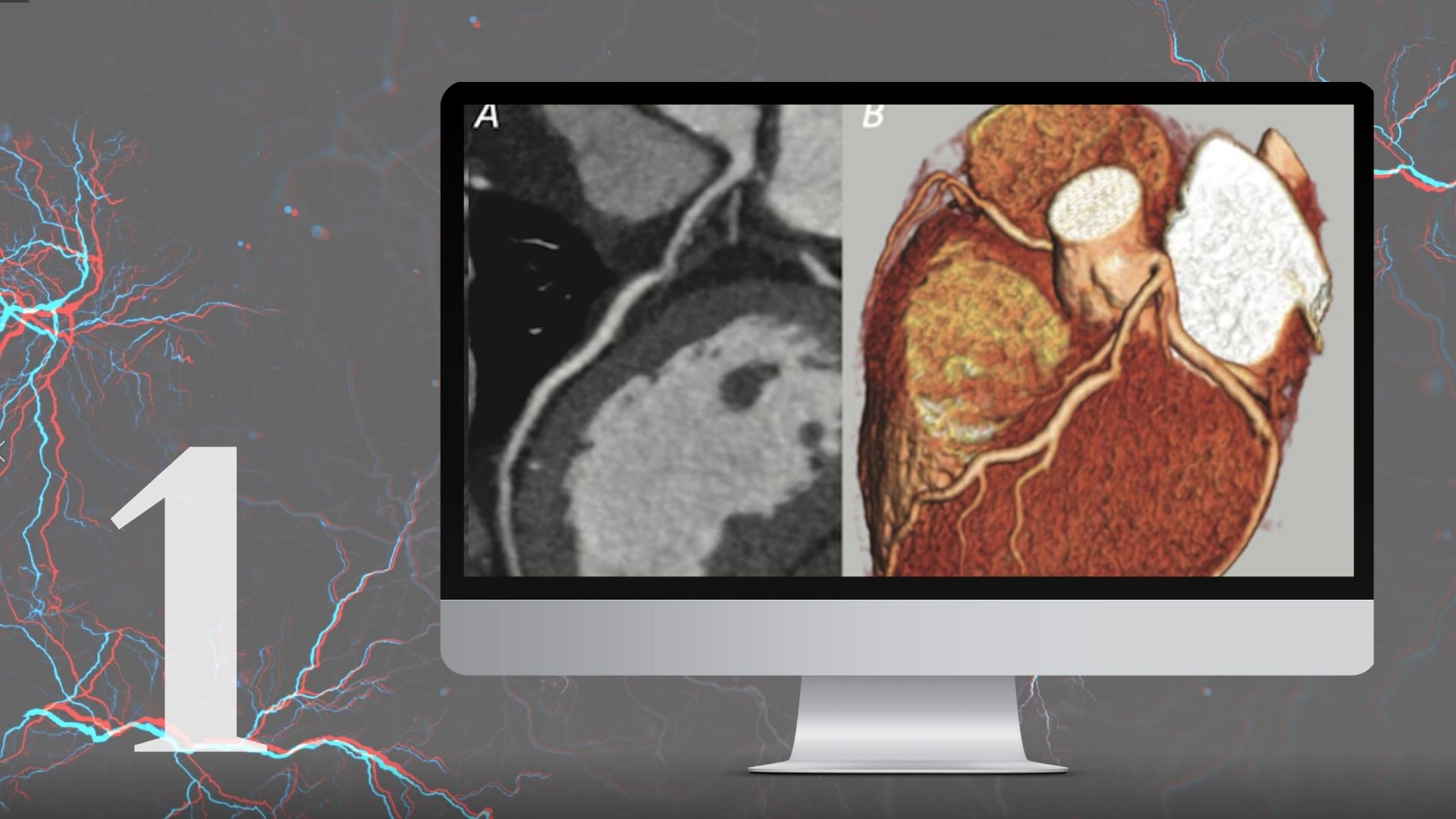 ¿Qué hacer con el resultado de una angiotomografía de coronarias ...