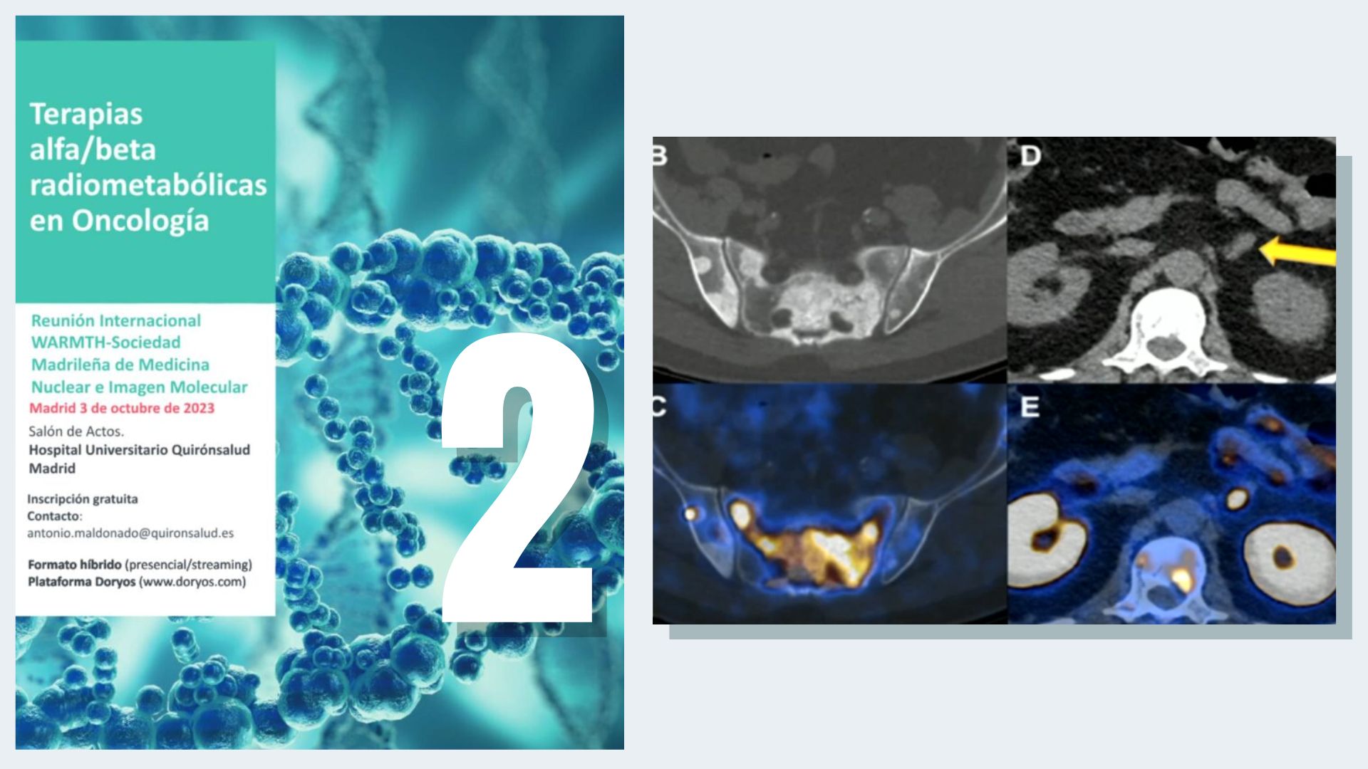 PET-CT con trazadores PSMA en el diagnóstico del cáncer de próstata ...