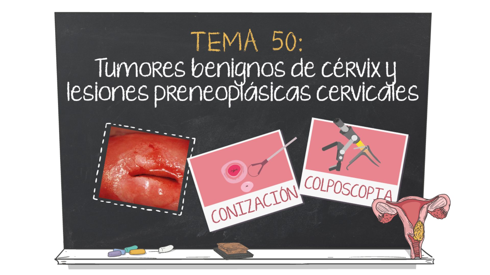 TEMA 50: Tumores benignos de cérvix y lesiones preneoplásicas ...