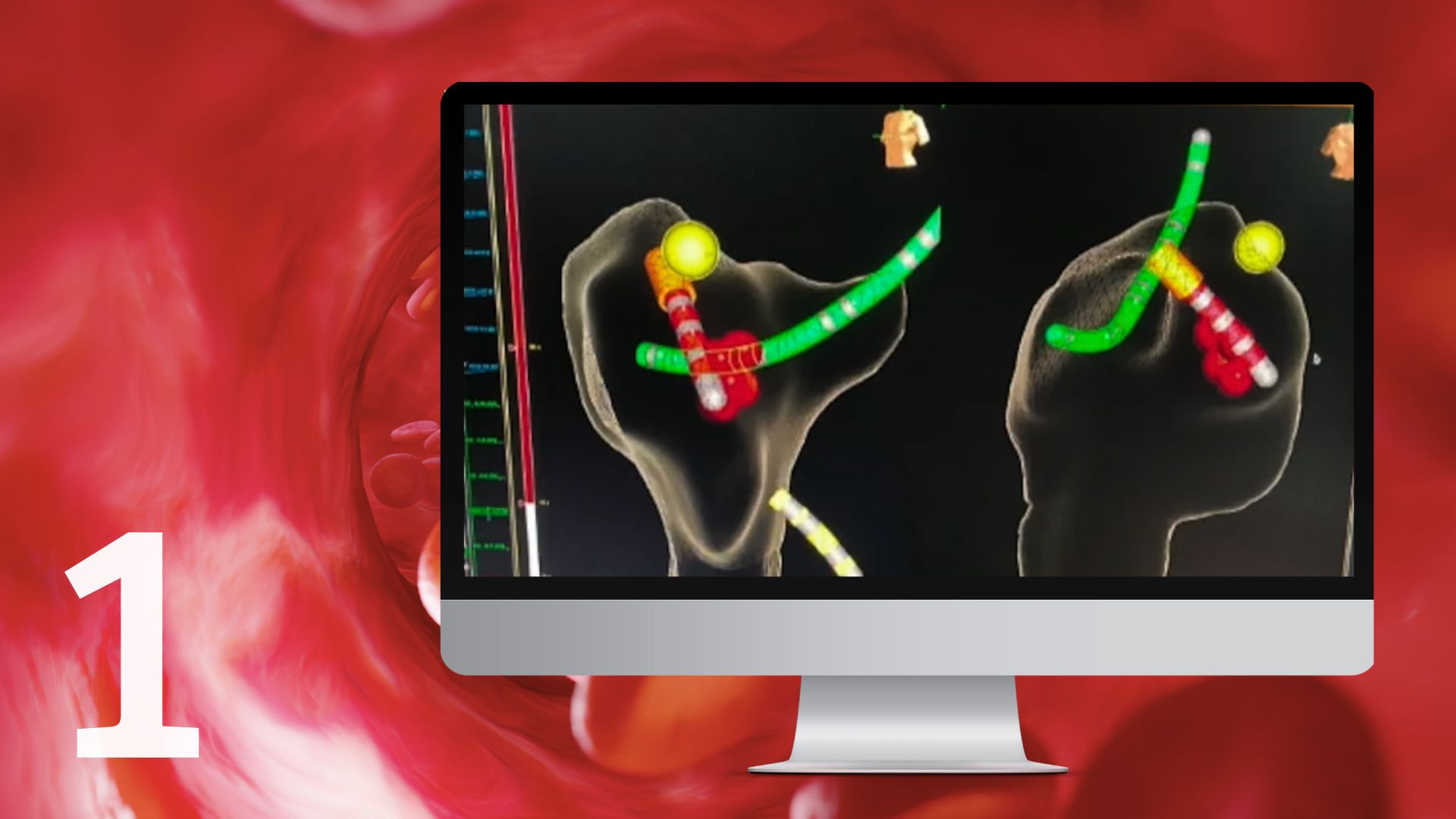 Fluoroscopia, ECO intracardiaco y mapeo 3D, parte 1 : Doryos