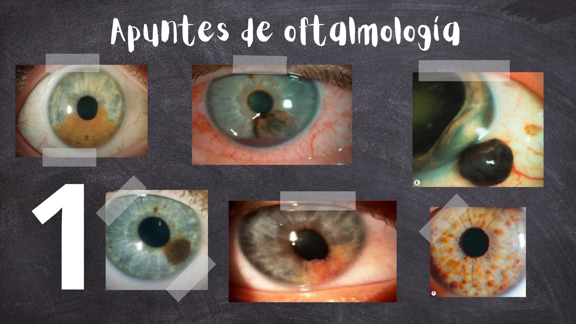 Tumores intraoculares: tumores del iris, tumores uveales y tumores del ...