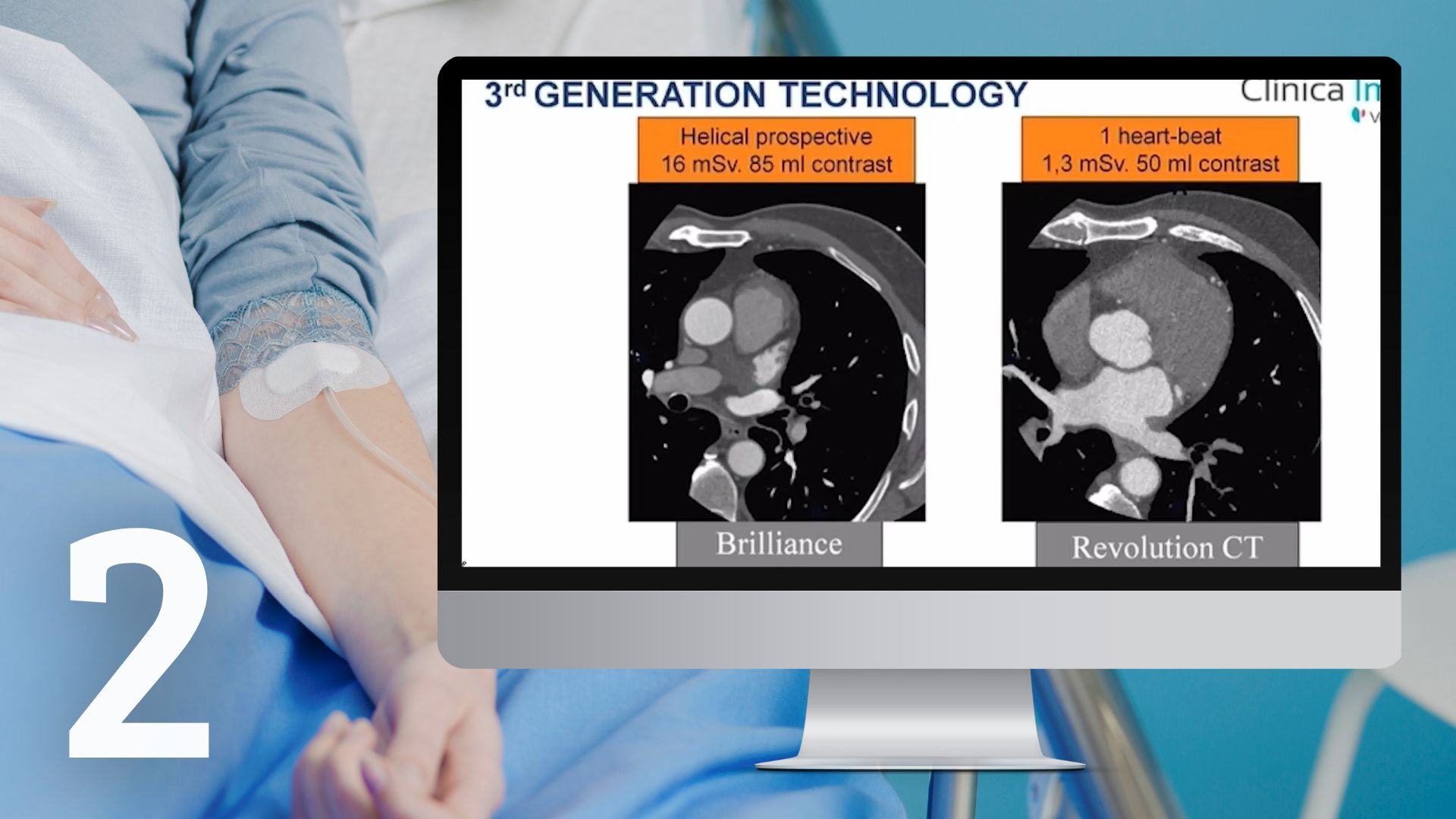 El AngioTAC Coronario está de moda: ¿Cuál es su indicación en el ...