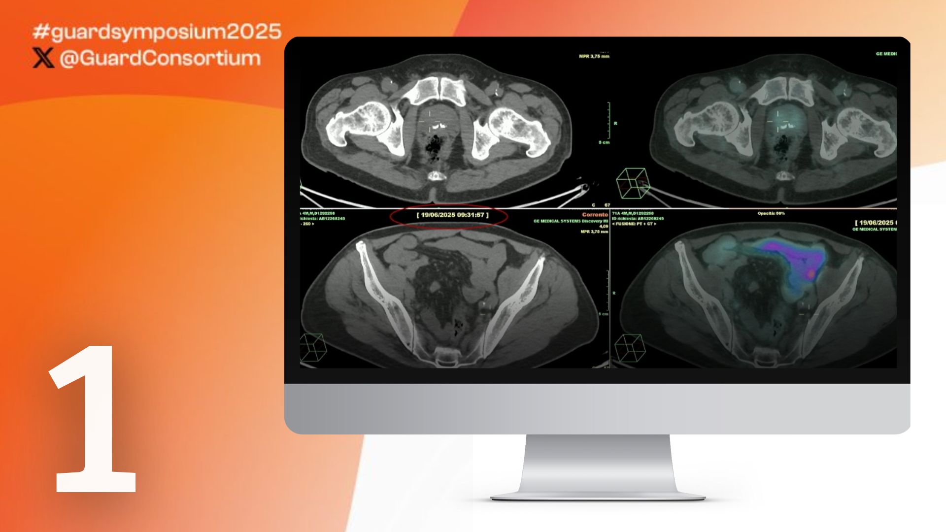 Estadificación del cáncer de próstata localizado de alto riesgo con PET ...